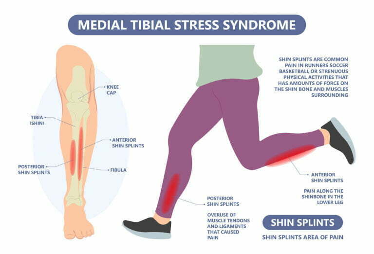 Medial Tibial Stress Syndrome - Shockwave & EMTT Therapy Now